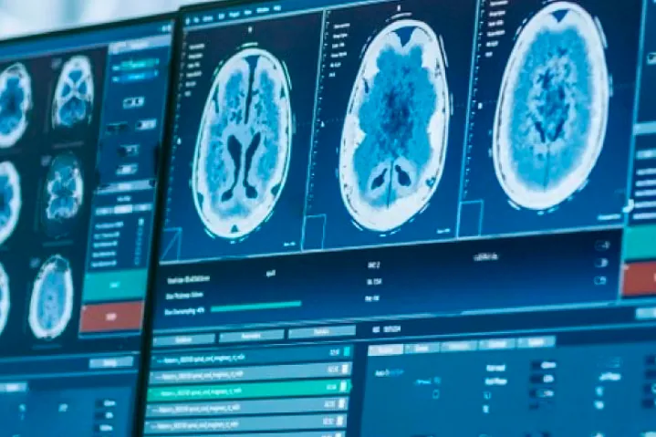Unirisco y Xesgalicia invierten en Batea Oncology para impulsar su tratamiento de Glioblastoma ...